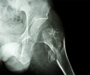 Bone Fracture - Dr Stuart MacKenzie